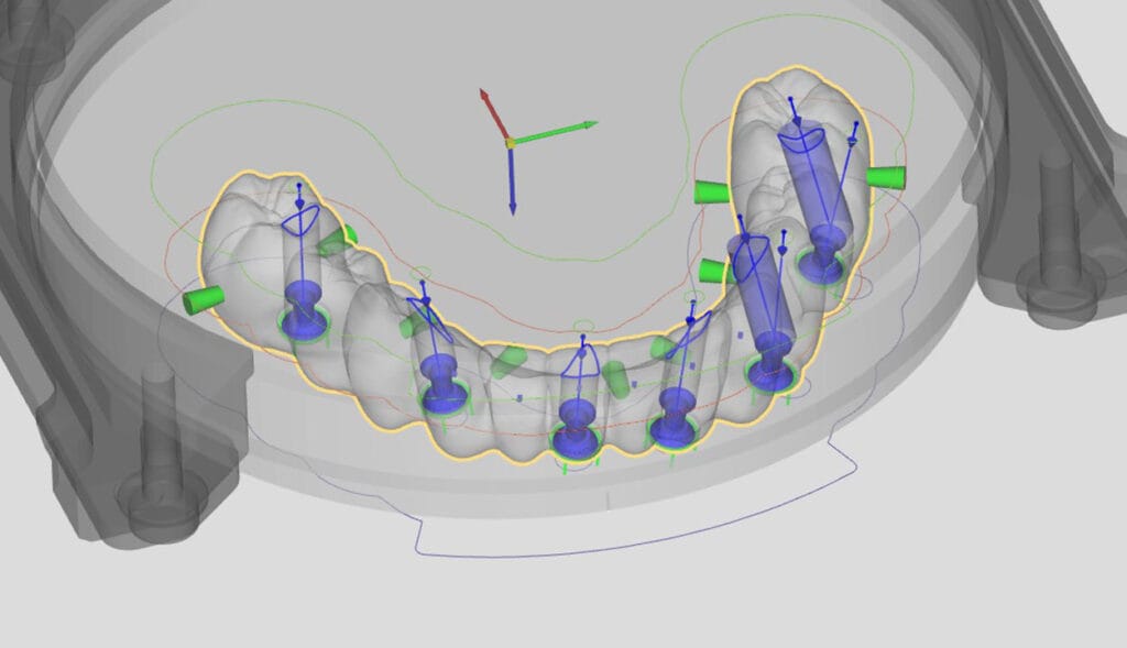 hyperDENT® Dental CAM Software | 3D Prime Technologies